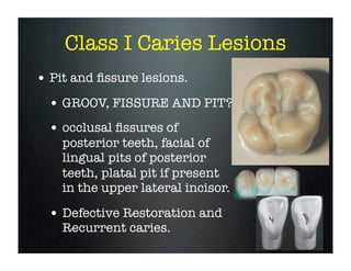 amalgam cavity preparation class i | PDF
