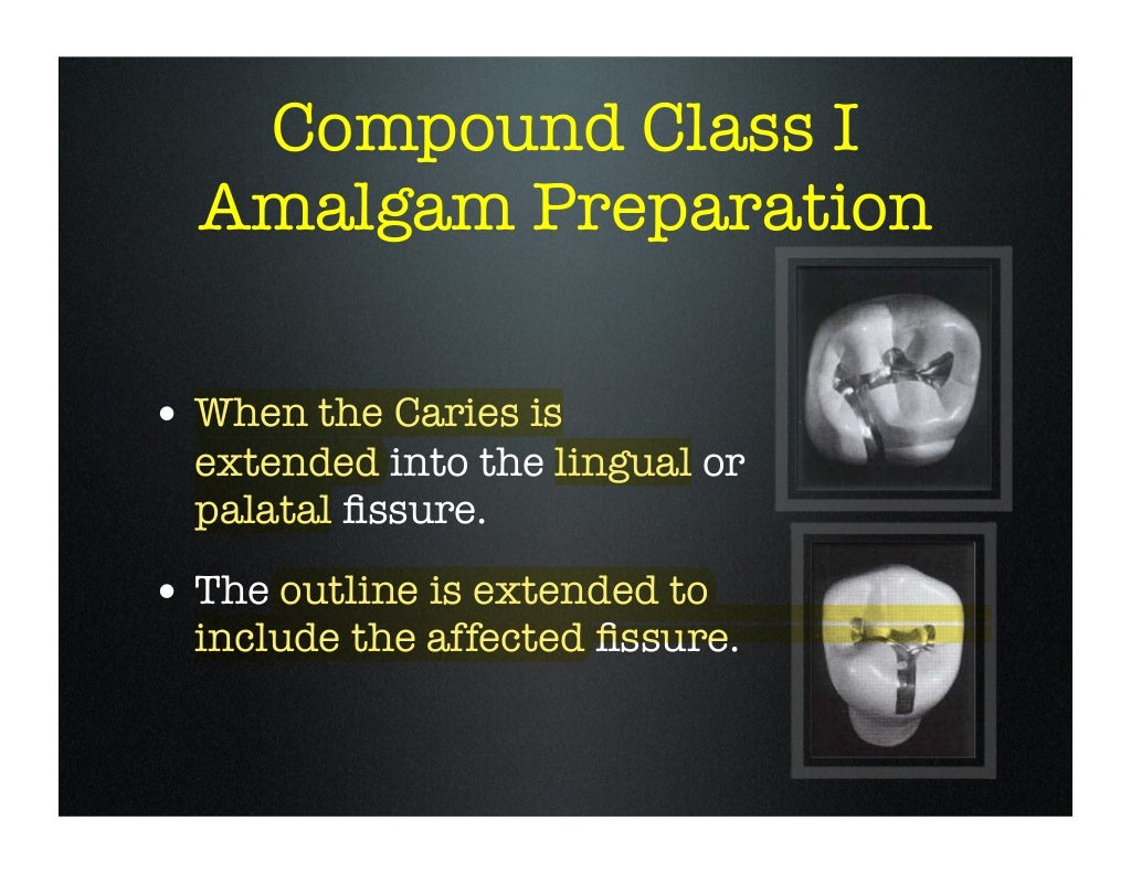 amalgam cavity preparation class i