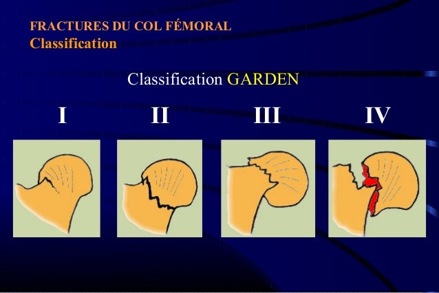 7.fracturi mb inf fr