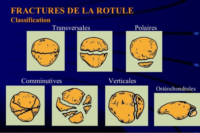 7.fracturi mb inf fr