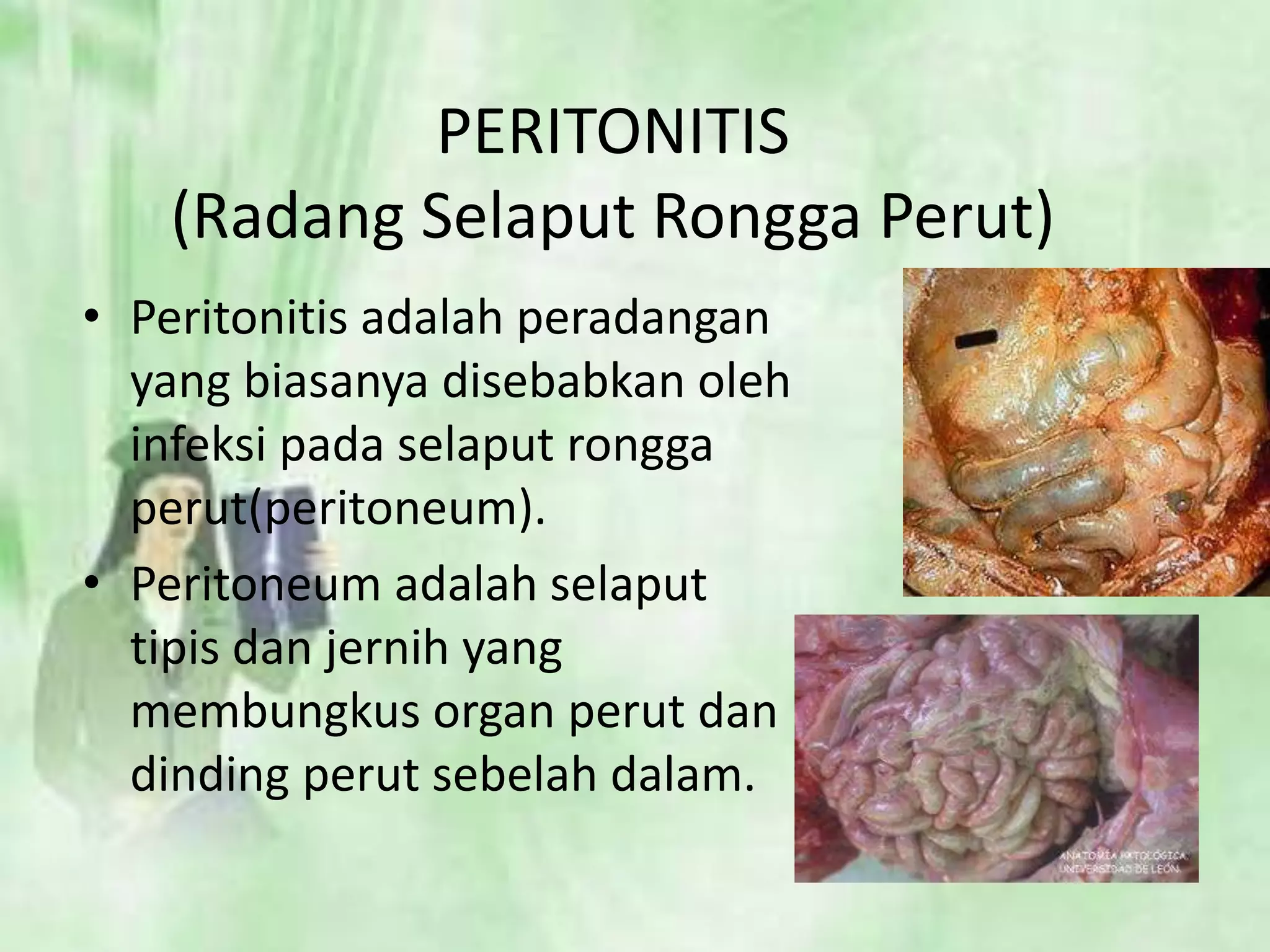 7. peritonitis | PPTX