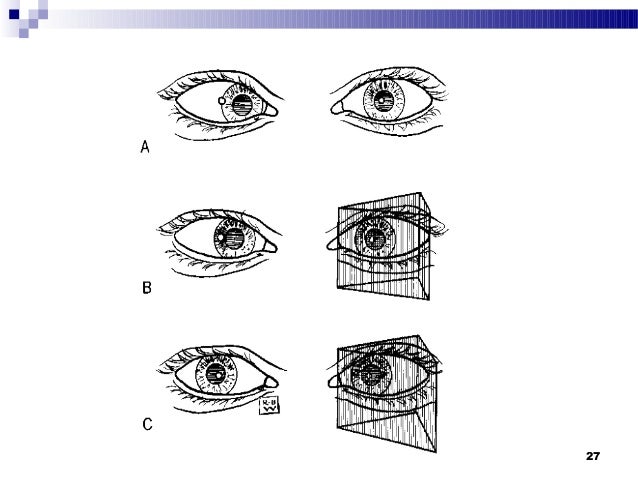 Motor evaluation of strabismus | PPT