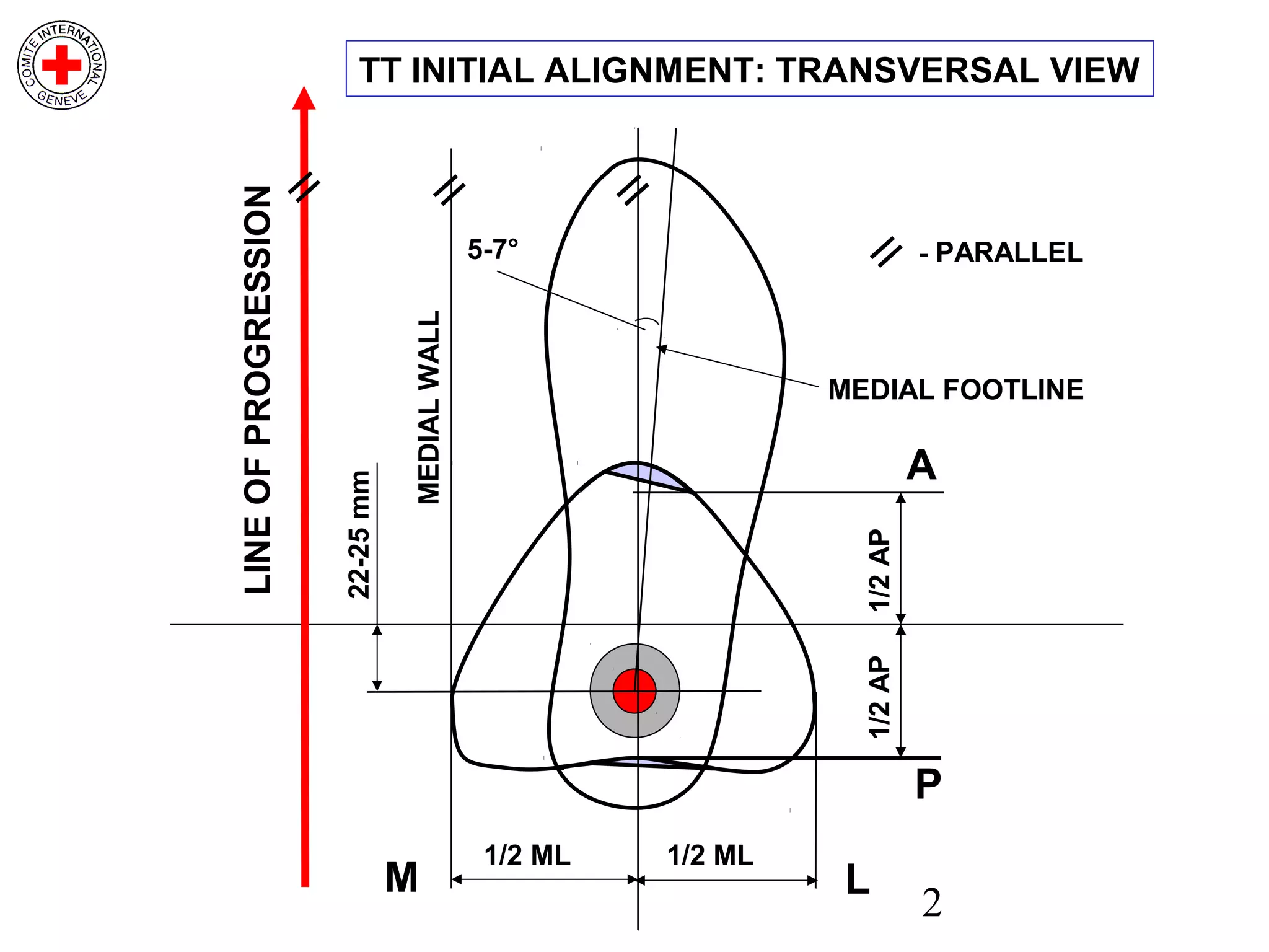 Transtibial Initial Alignment | PPT