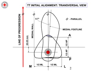 Transtibial Initial Alignment | PPT