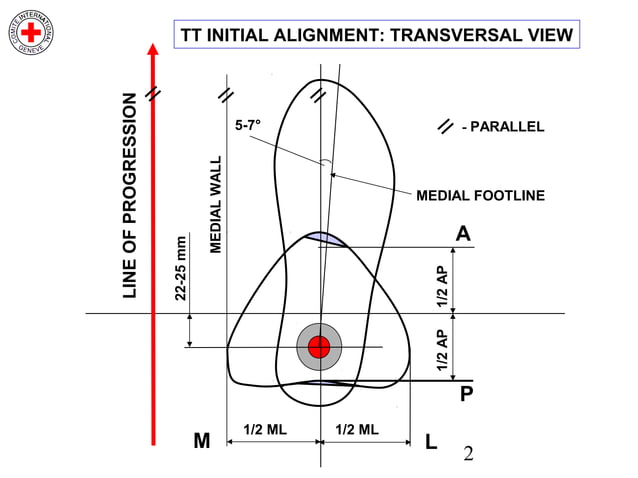 Transtibial Initial Alignment | PPT