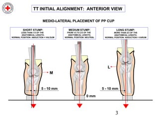 Transtibial Initial Alignment | PPT