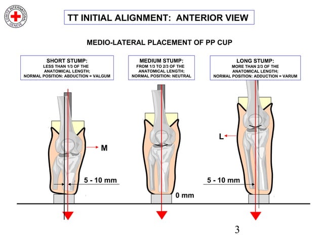Transtibial Initial Alignment | PPT