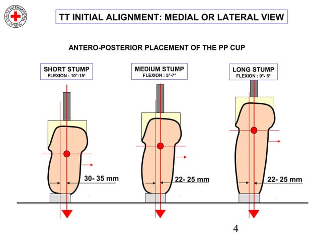 Transtibial Initial Alignment | PPT