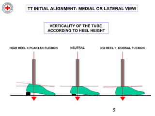 Transtibial Initial Alignment | PPT