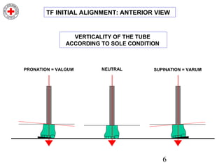 Transtibial Initial Alignment | PPT