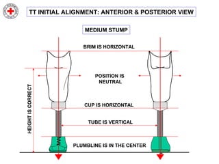 Transtibial Initial Alignment | PPT