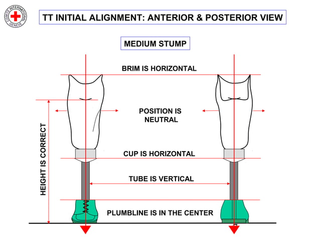 Transtibial Initial Alignment | PPT
