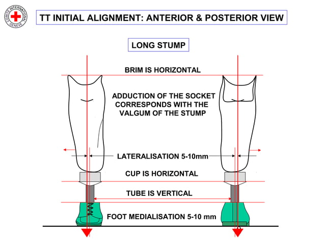 Transtibial Initial Alignment | PPT
