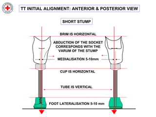 Transtibial Initial Alignment | PPT