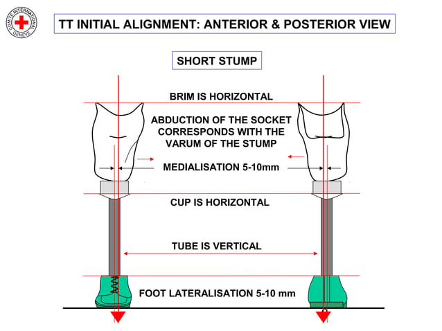 Transtibial Initial Alignment | PPT