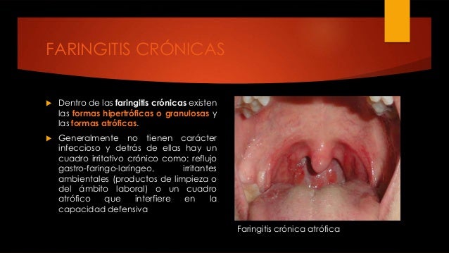 Semiología de faringitis y amigdalitis