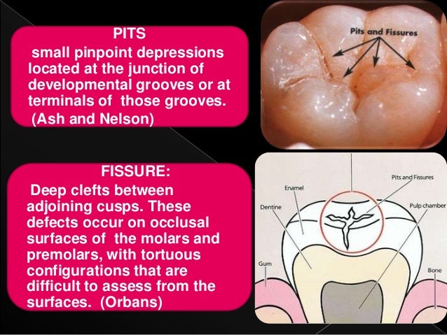 Pit and fissure sealants