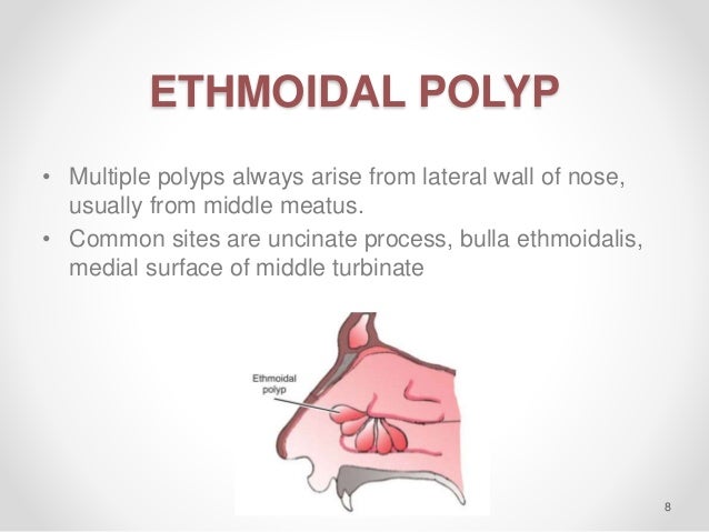 Nasal Polyps Pictures Symptoms Nasal Polyp Causes Symptoms Diagnosis