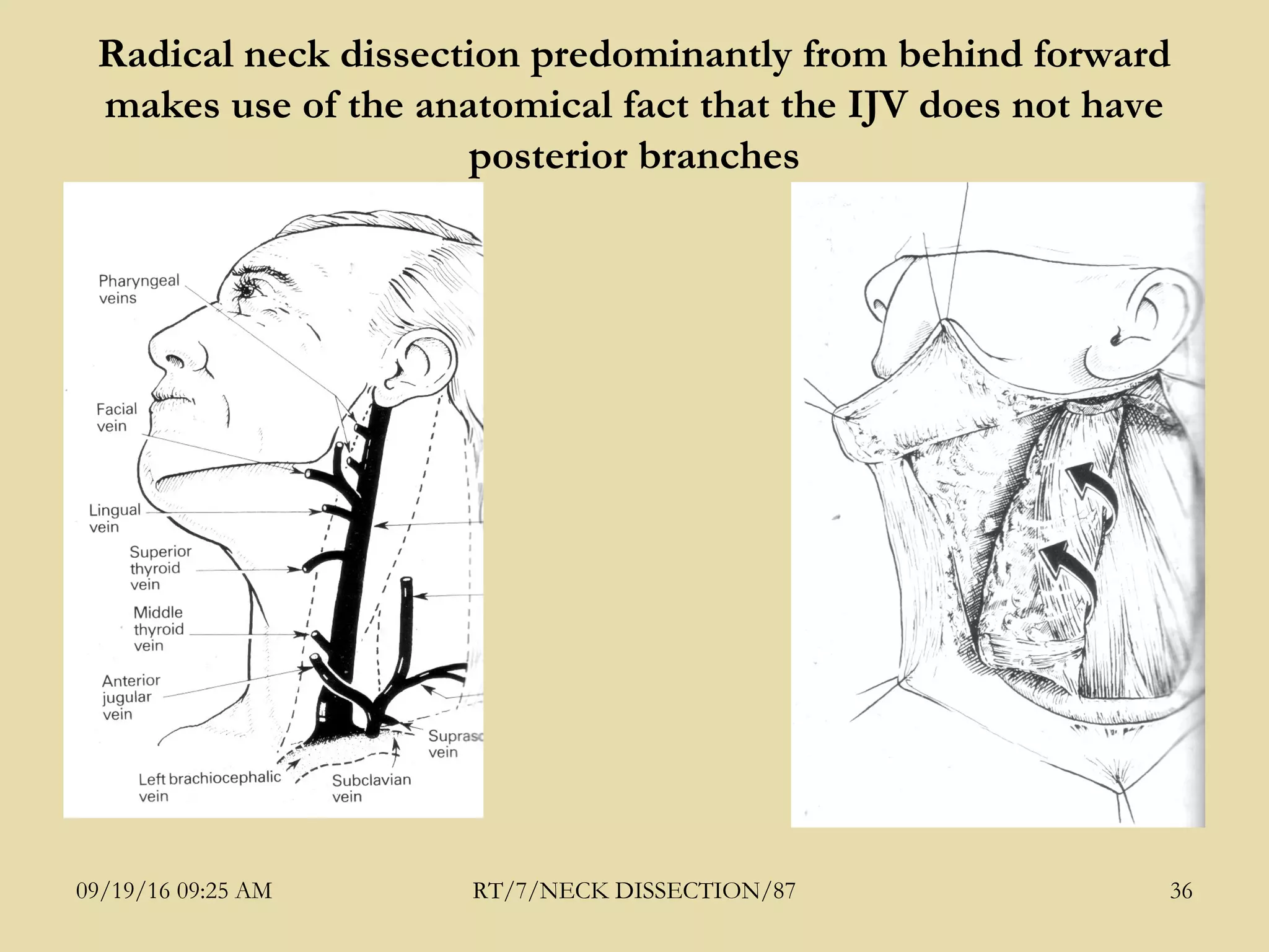 7. neck dissection(87) Dr. RAHUL TIWARI | PPT