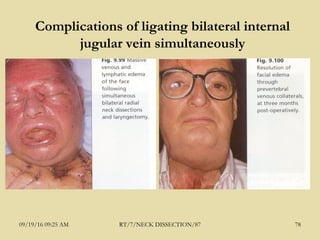 Radical Neck Dissection Post Op