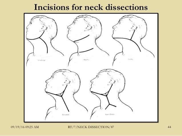 7. neck dissection(87) Dr. RAHUL TIWARI