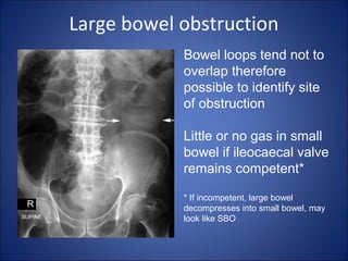 Abdominal X ray | PDF
