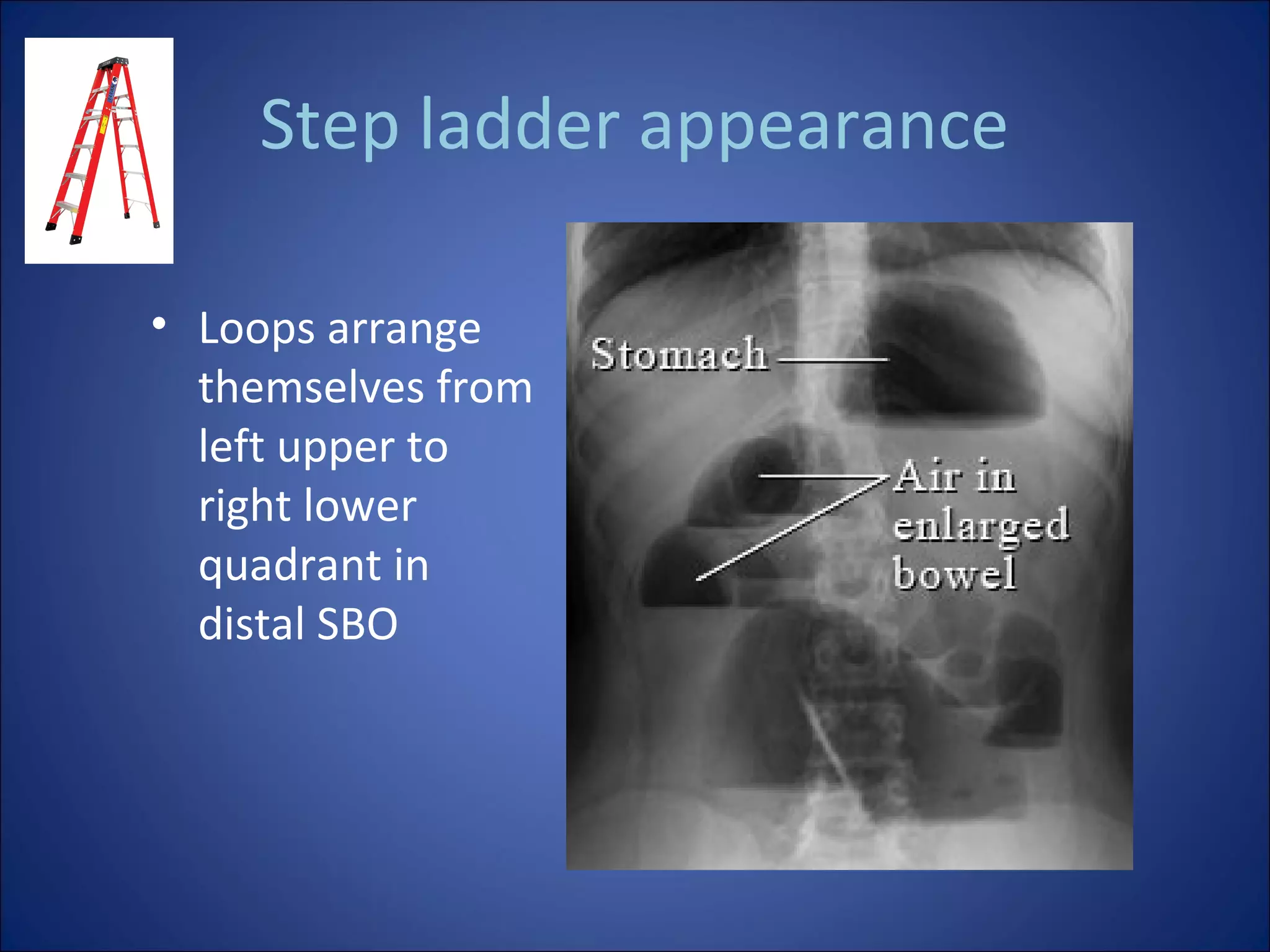 Abdomen xray signs | PPT