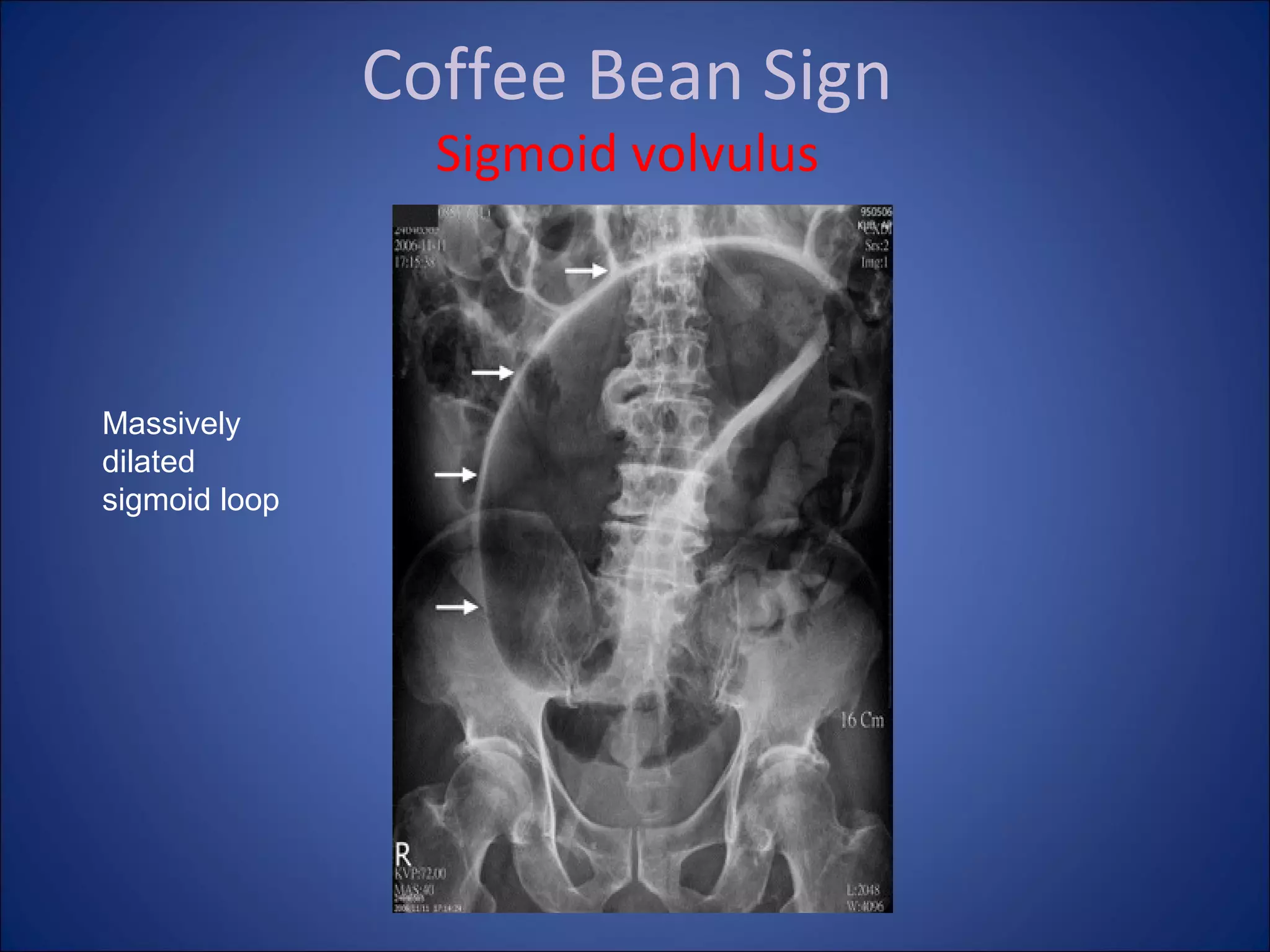 Abdomen xray signs | PPT