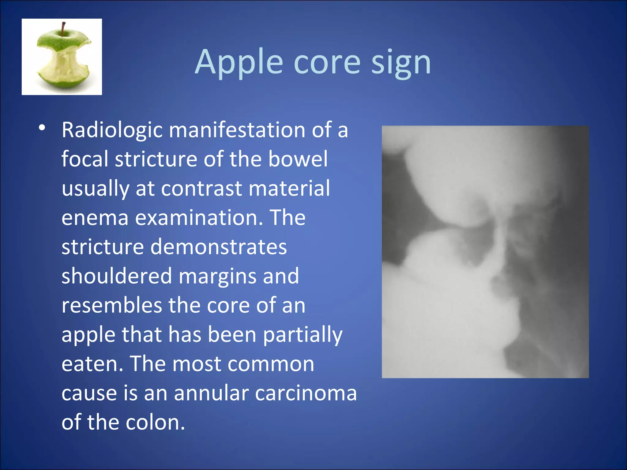 Abdomen xray signs | PPT