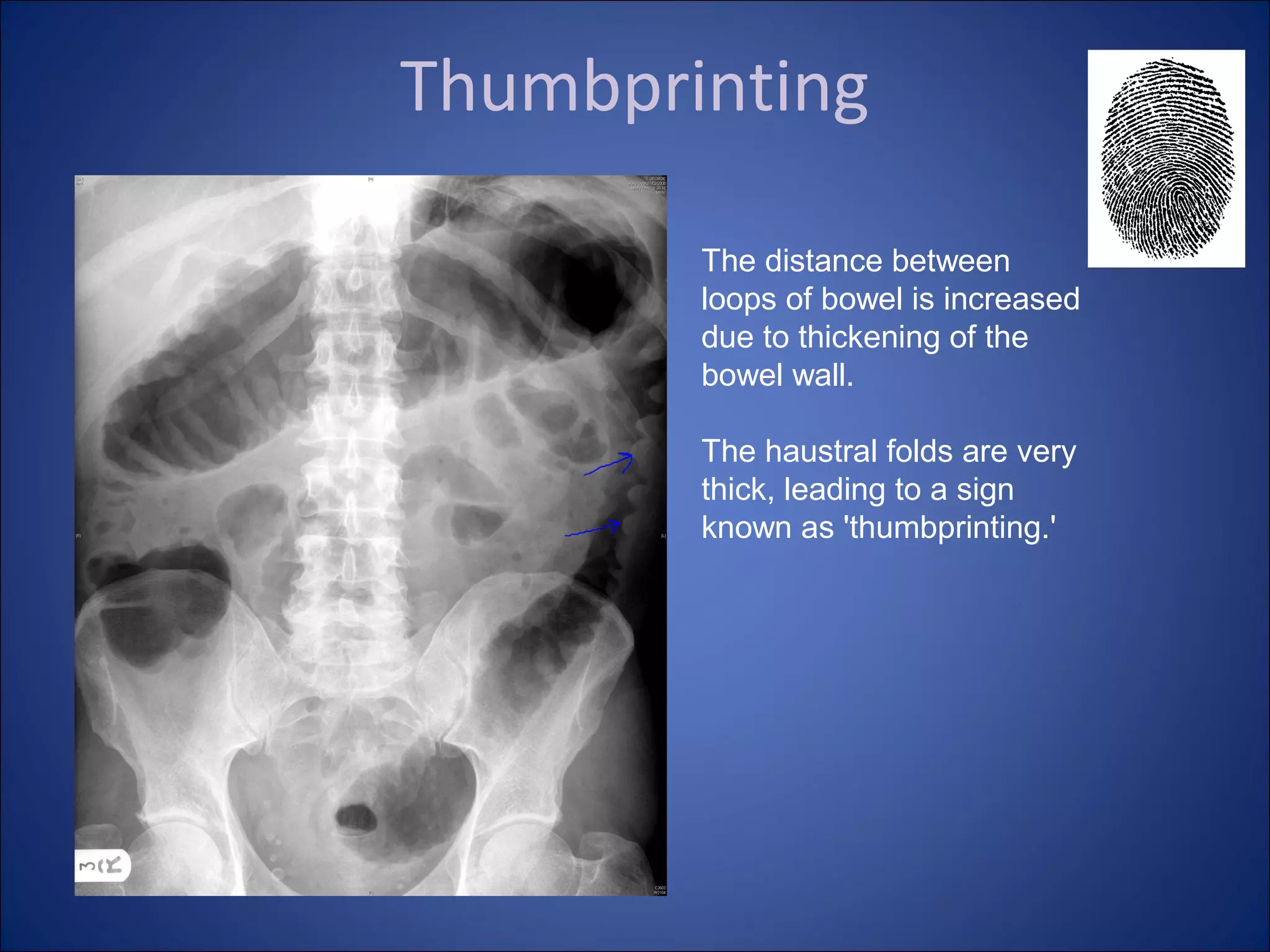 Abdomen xray signs | PPT