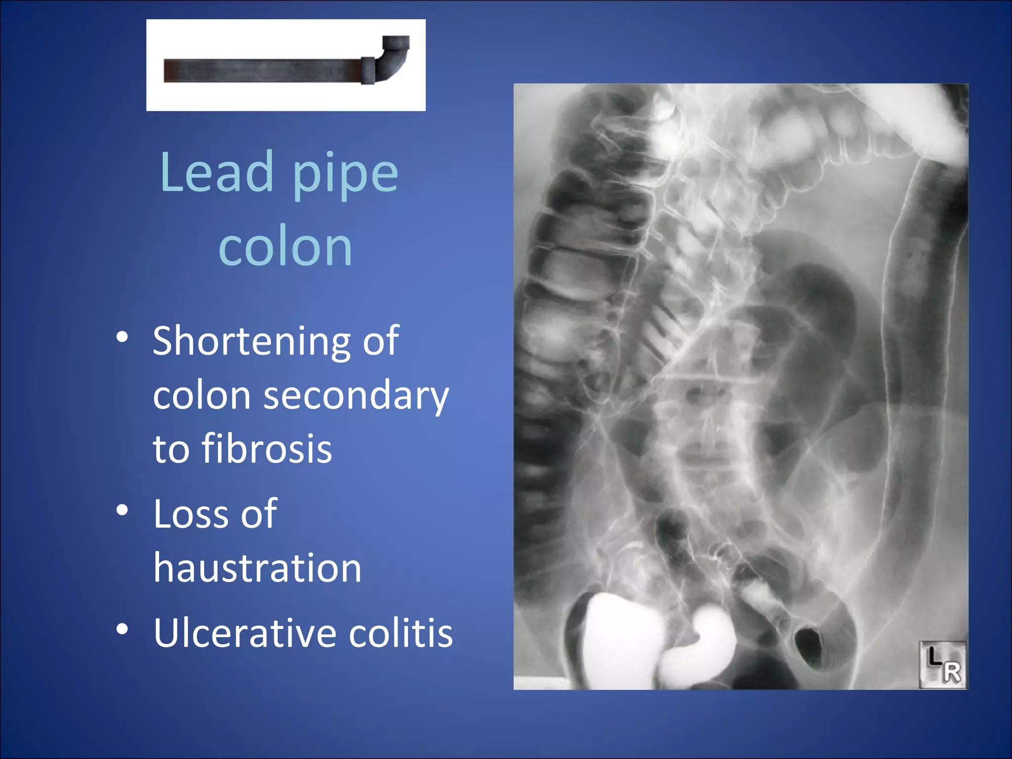 Abdomen xray signs | PPT