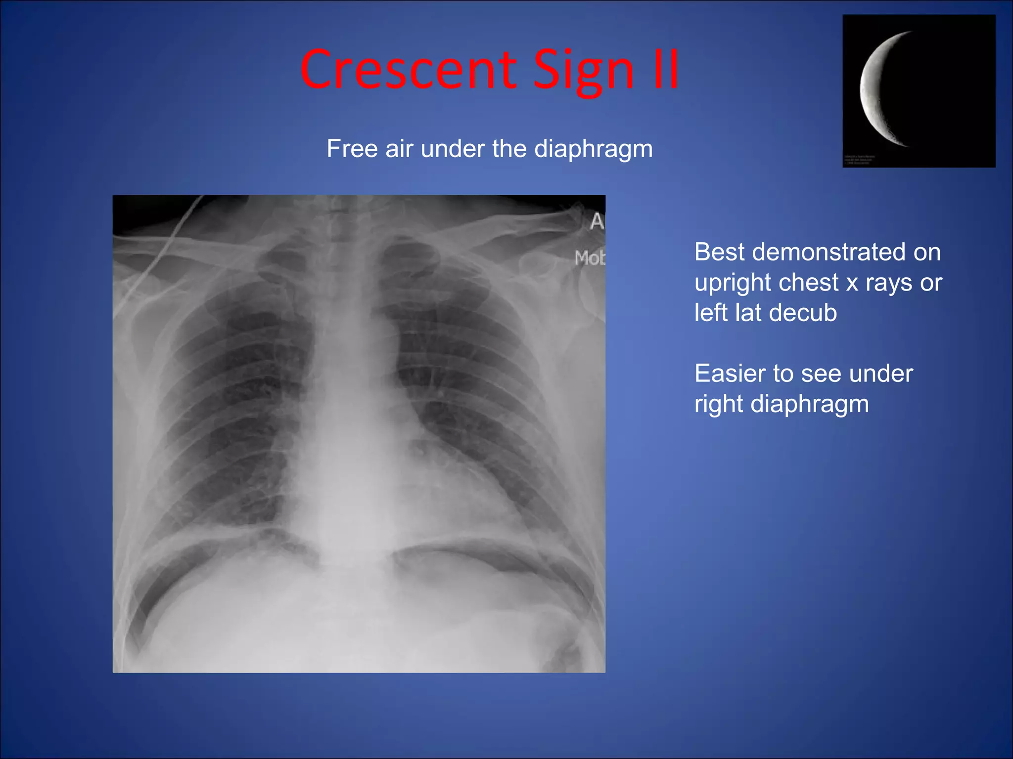 Abdomen xray signs | PPT