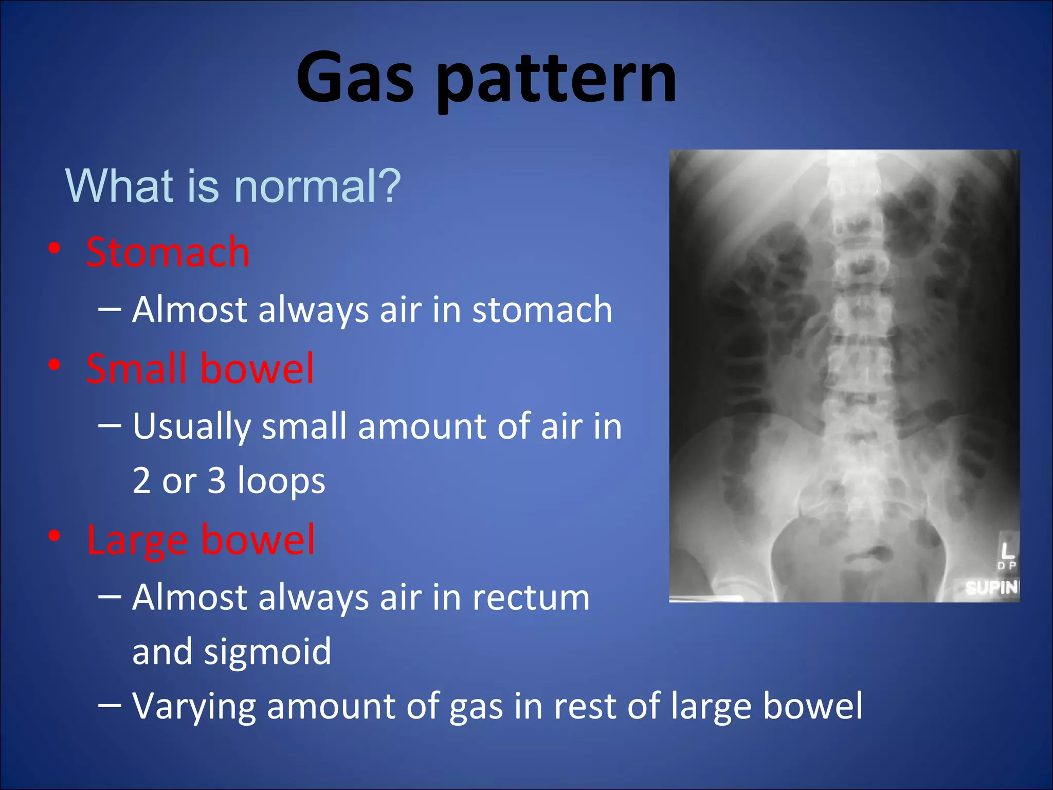 Abdomen xray signs | PPT