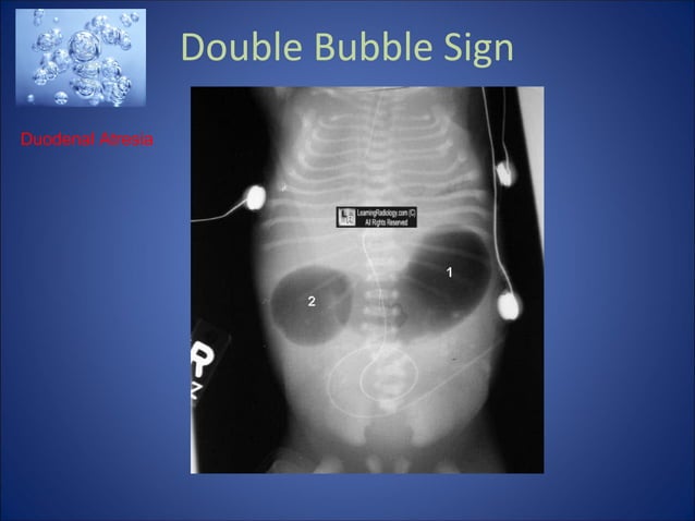 Abdomen xray signs | PPT