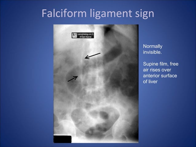 Abdomen xray signs | PPT