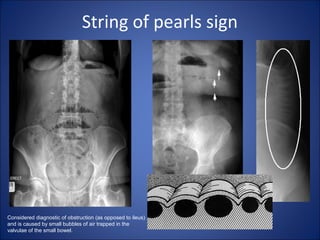 Abdomen xray signs | PPT