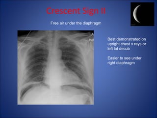 Intussusception Crescent Sign