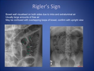Abdomen xray signs | PPT