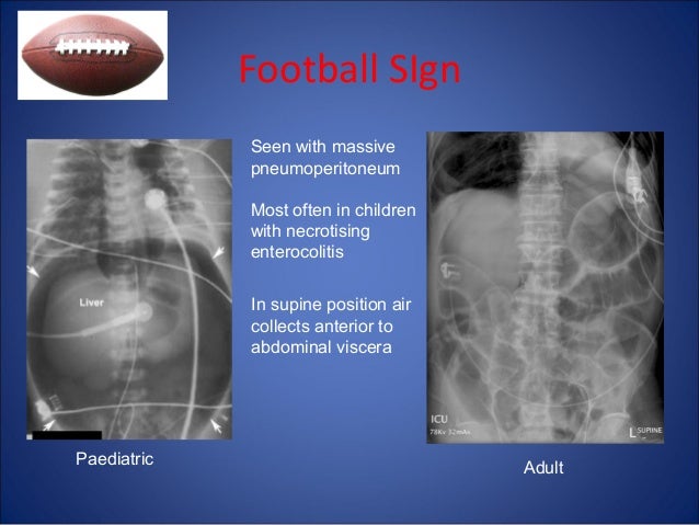 Abdomen xray signs