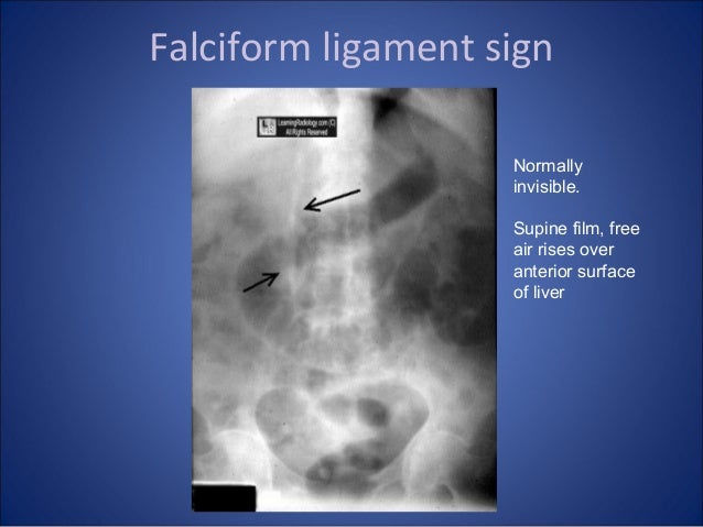 Abdomen xray signs