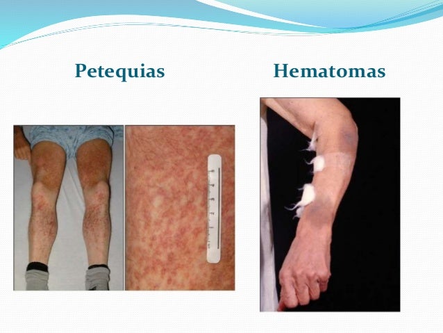leucemias agudas - hematologia