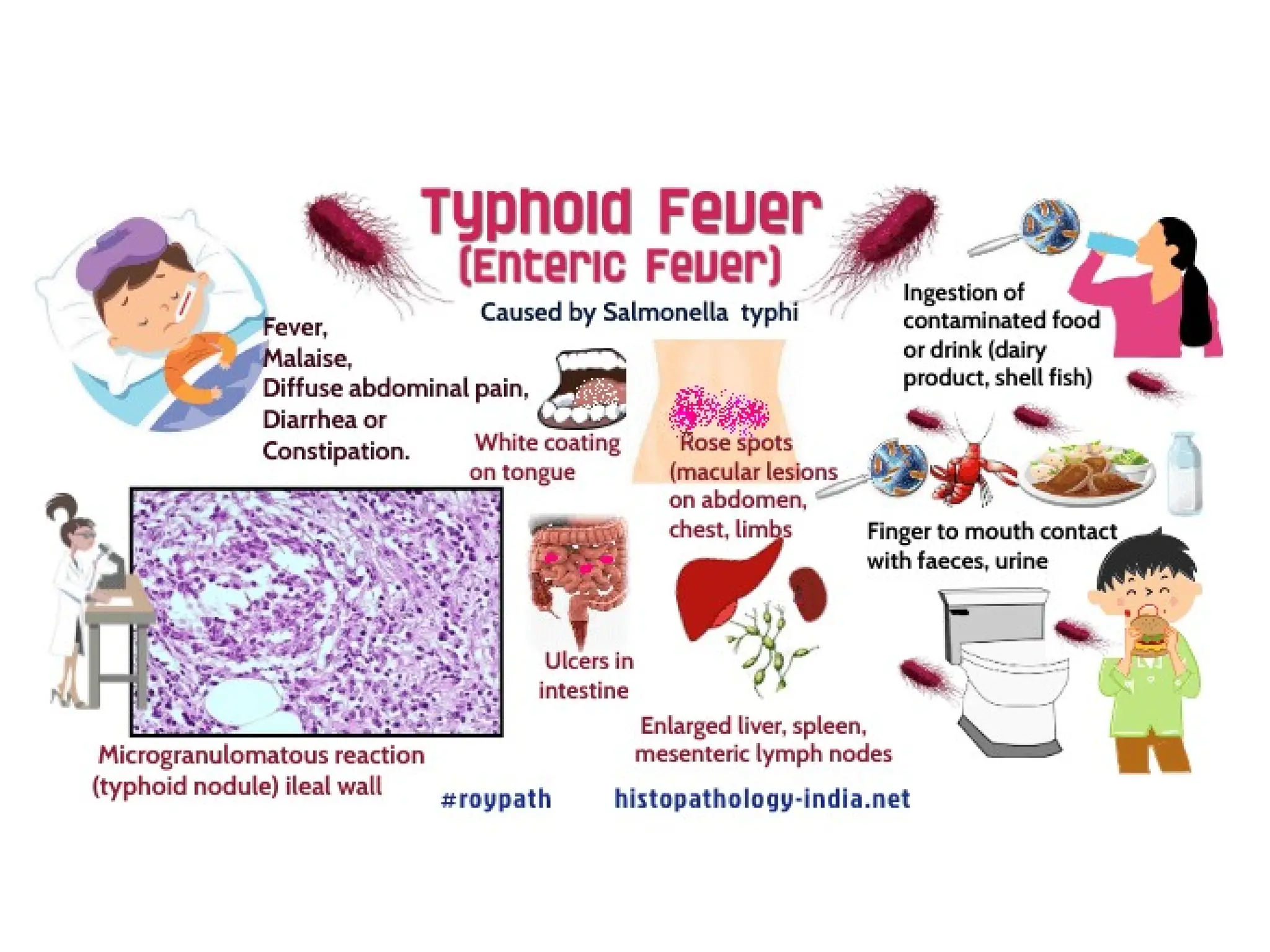 typhoid fever full notes with explanation | PPTX