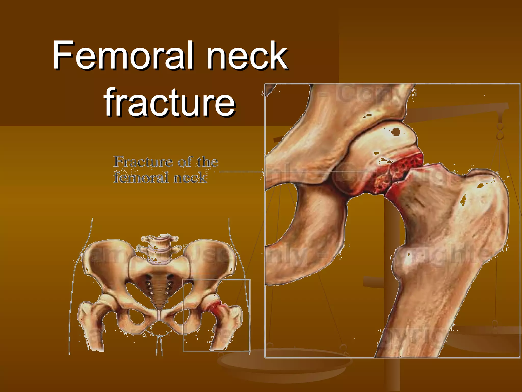 Fracture of Femur | PPT