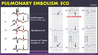 Pulmonary Embolism | PPTX
