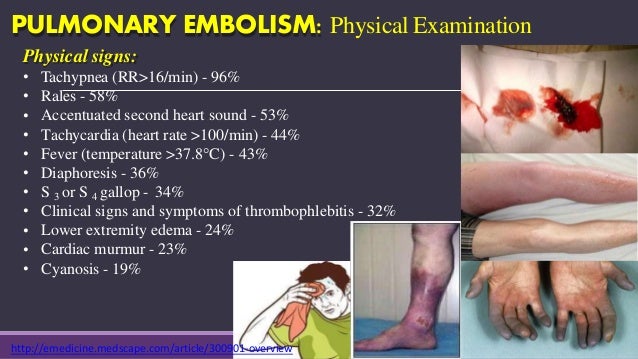 Pulmonary Embolism
