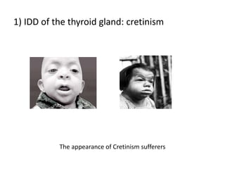 Iodine Deficiency Cretinism
