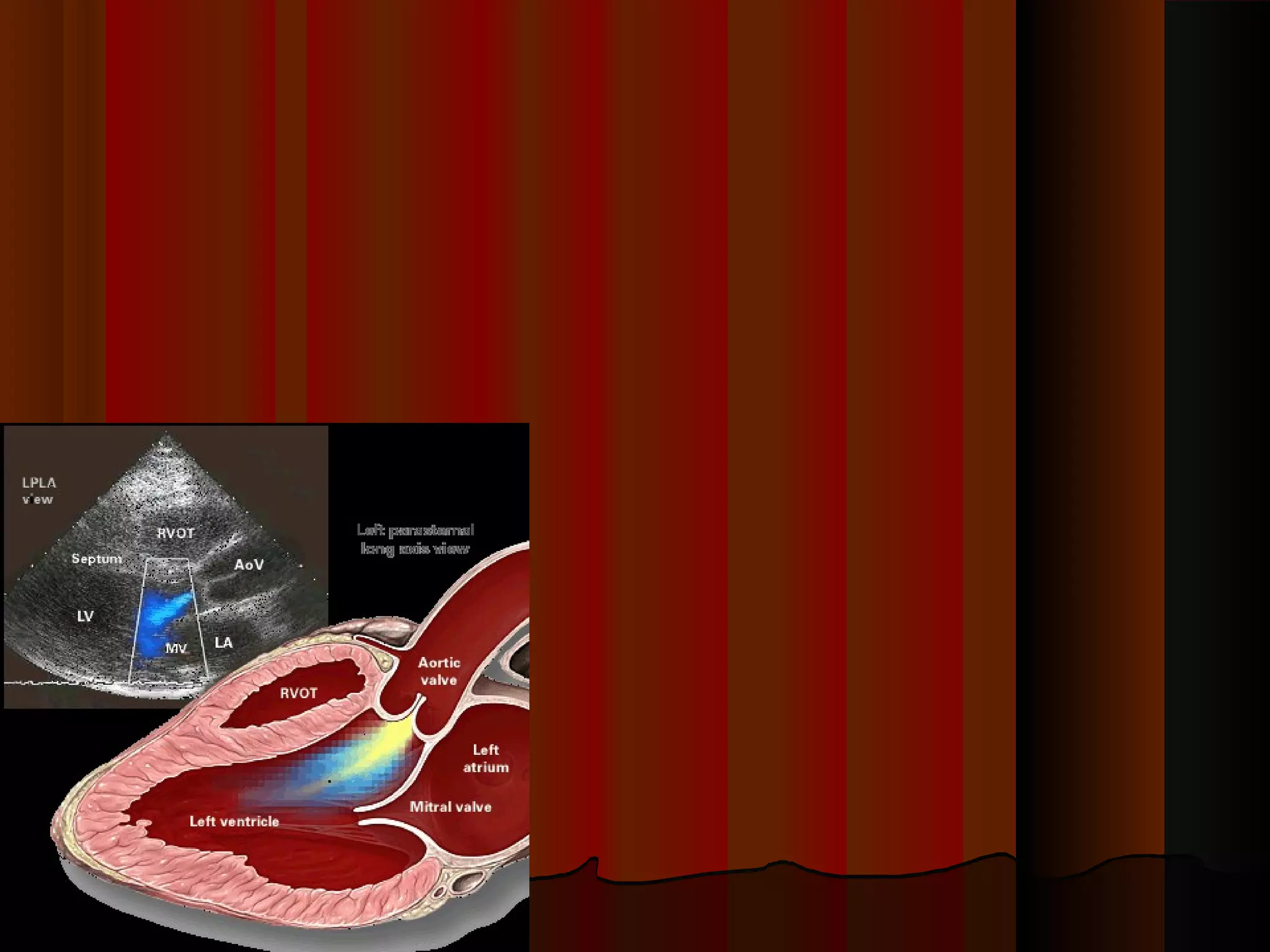 7.Valvular heart disease pathology | PPT