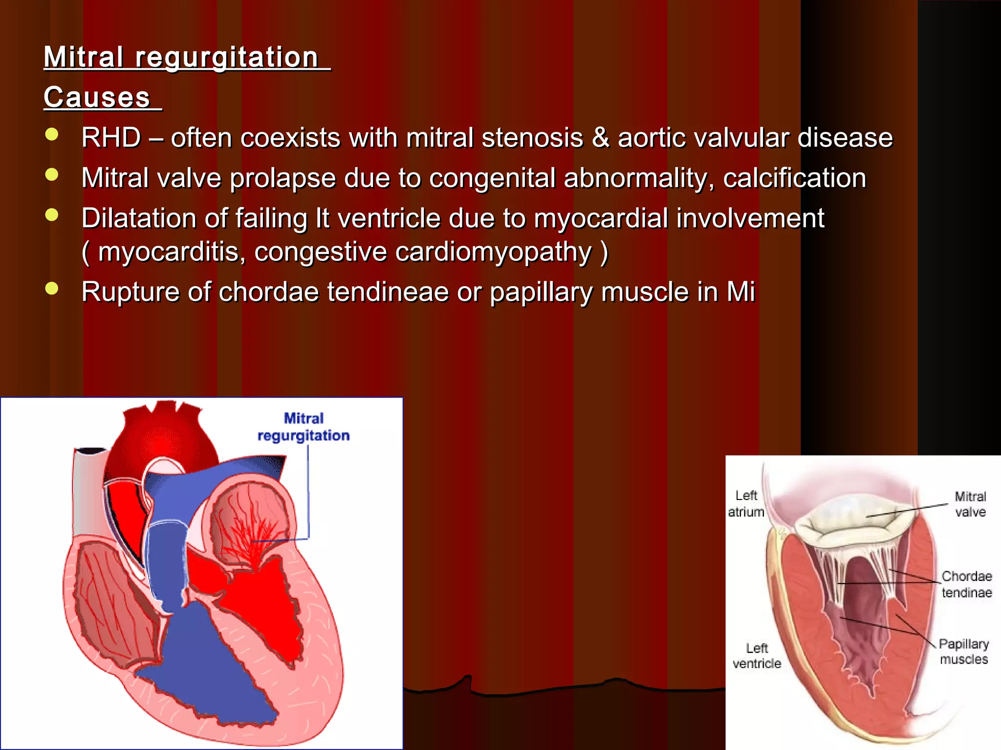 7.Valvular heart disease pathology | PPT