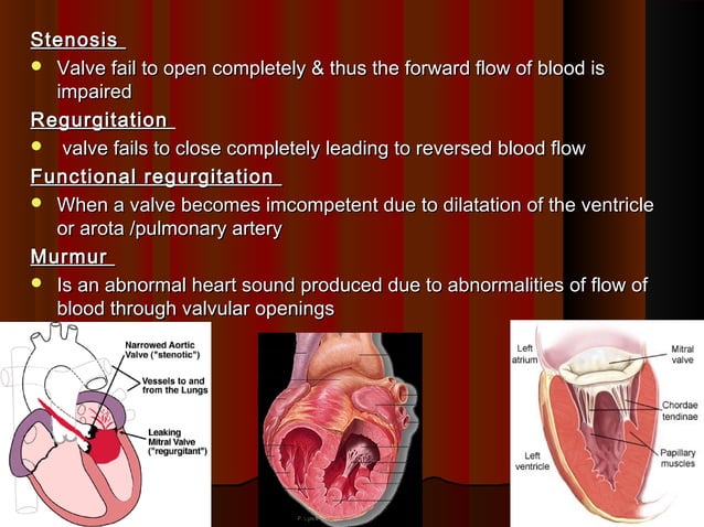 7.Valvular heart disease pathology | PPT