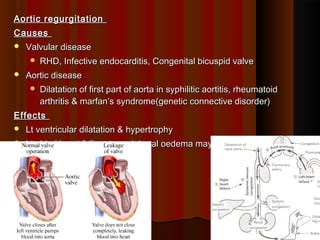 7.Valvular heart disease pathology | PPT